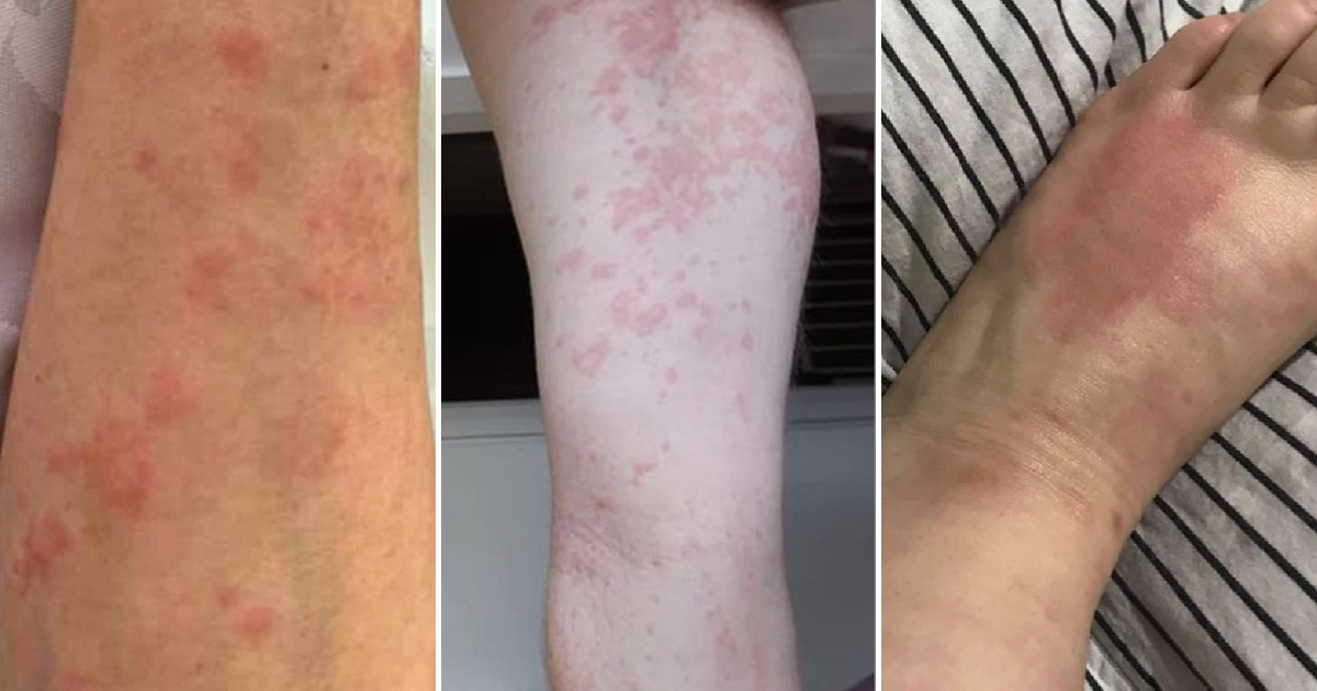 Hundreds Of People In Australia Are Struck Down By An Incurable And ...