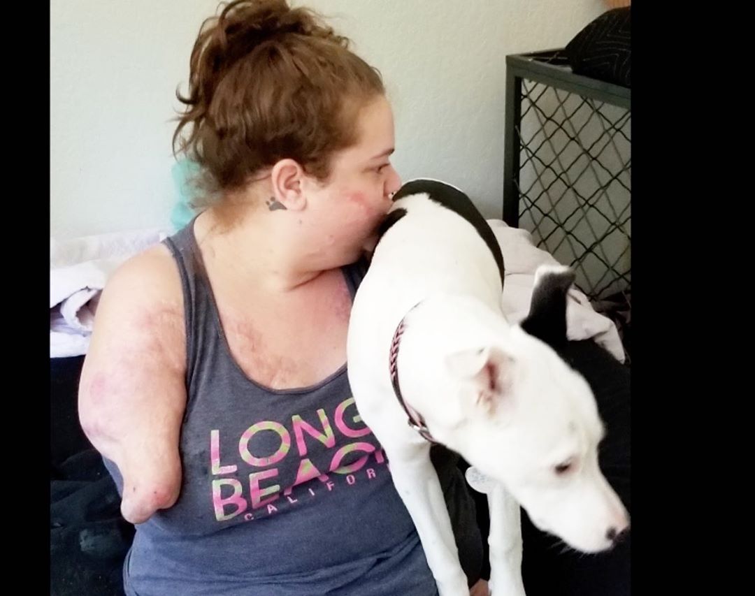 Woman Who Lost All Four Limbs Uses Prosthetics To Create Beautiful ...